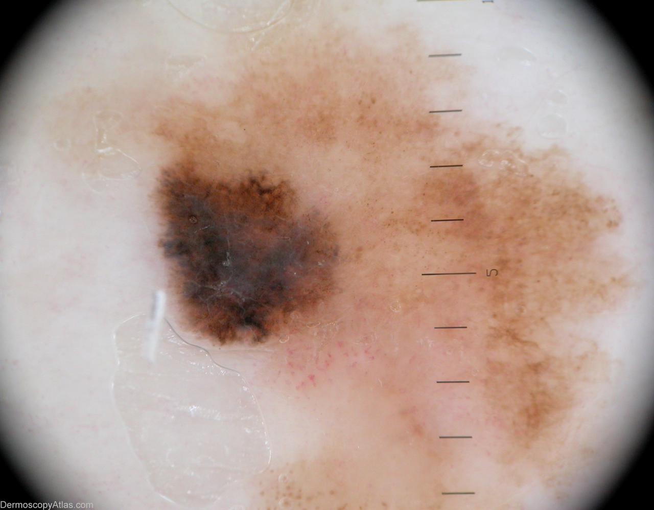 Gefährliche Muttermale erkennen — Dermtest: Muttermal-check direkt von ...